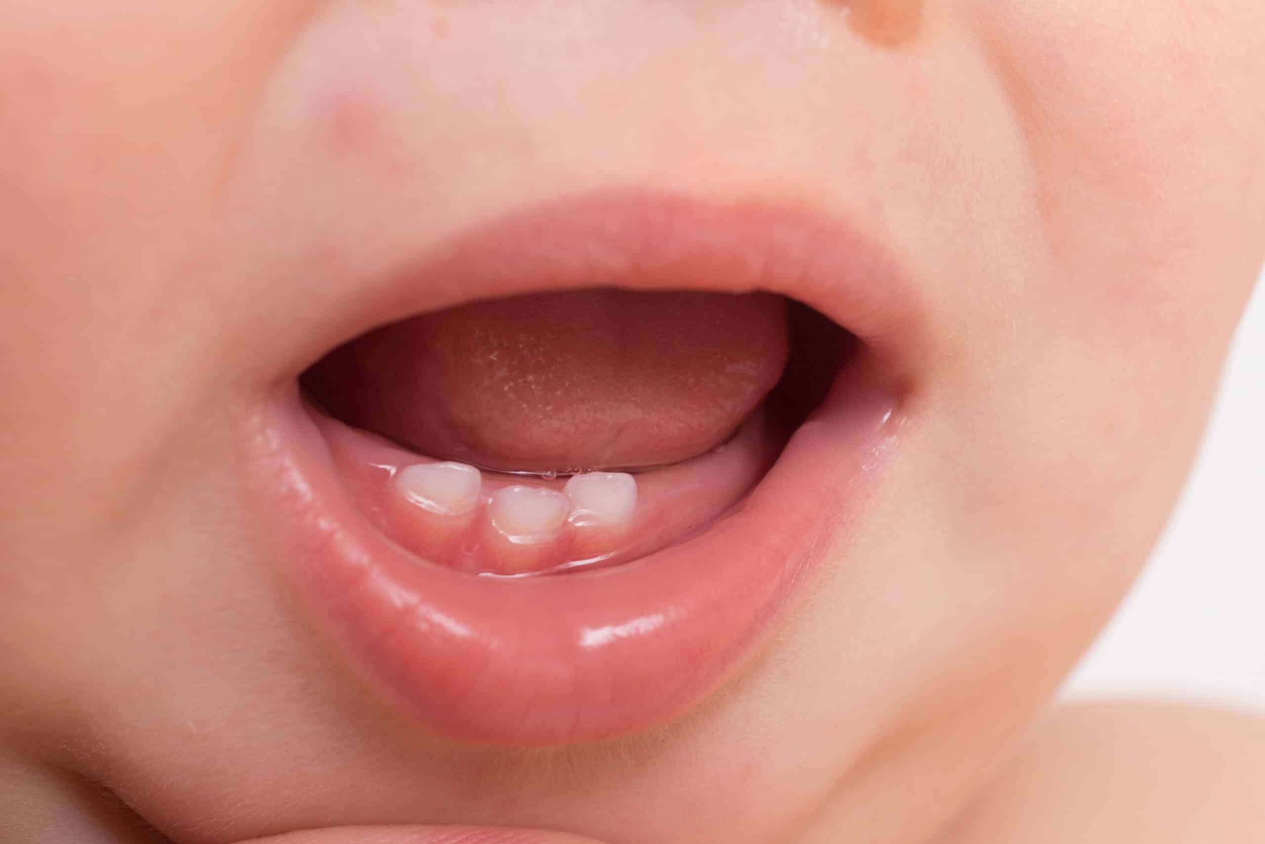 Comprehensive Guide to Infant Dentistry